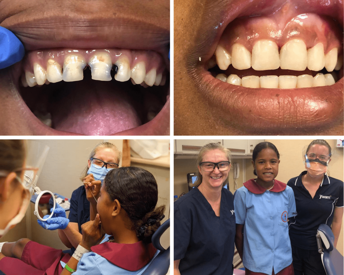 Young Girl's Smile Shines Again After Treatment in the YWAM Dental Trailer - YWAM Medical Ships ...